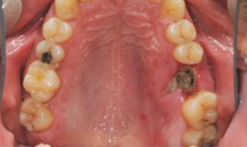 Mastering Swallowing Preventing Dry Socket Mastering Swallowing Preventing Dry Socket