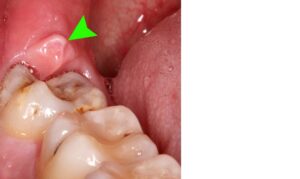 Tooth Infection Swollen Lymph Nodes: Symptoms & Treatment